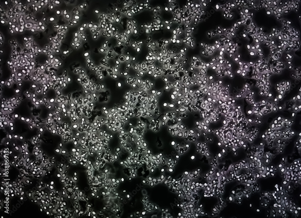 Budding yeast cells in patient urine (urinary tract infections ...