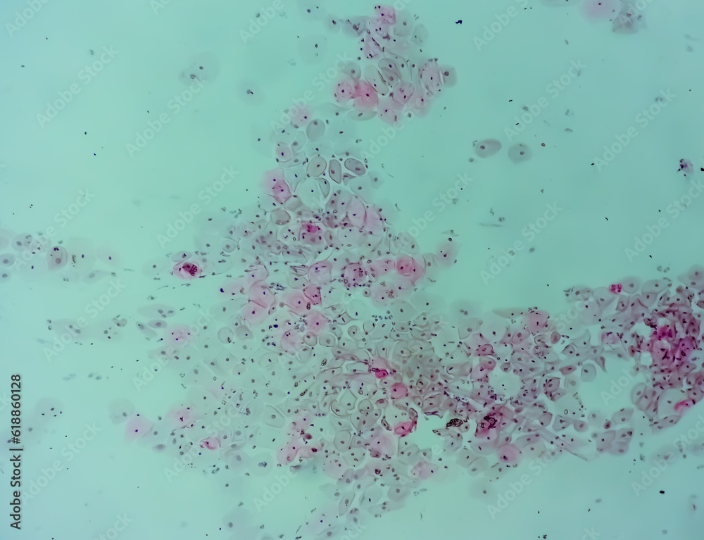 Paps smear: Inflammatory smear with HPV related changes. Cervical ...