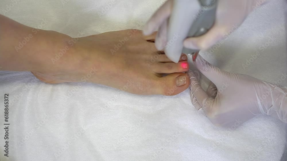 Top view woman doctor doing laser treatment procedure for toenail ...