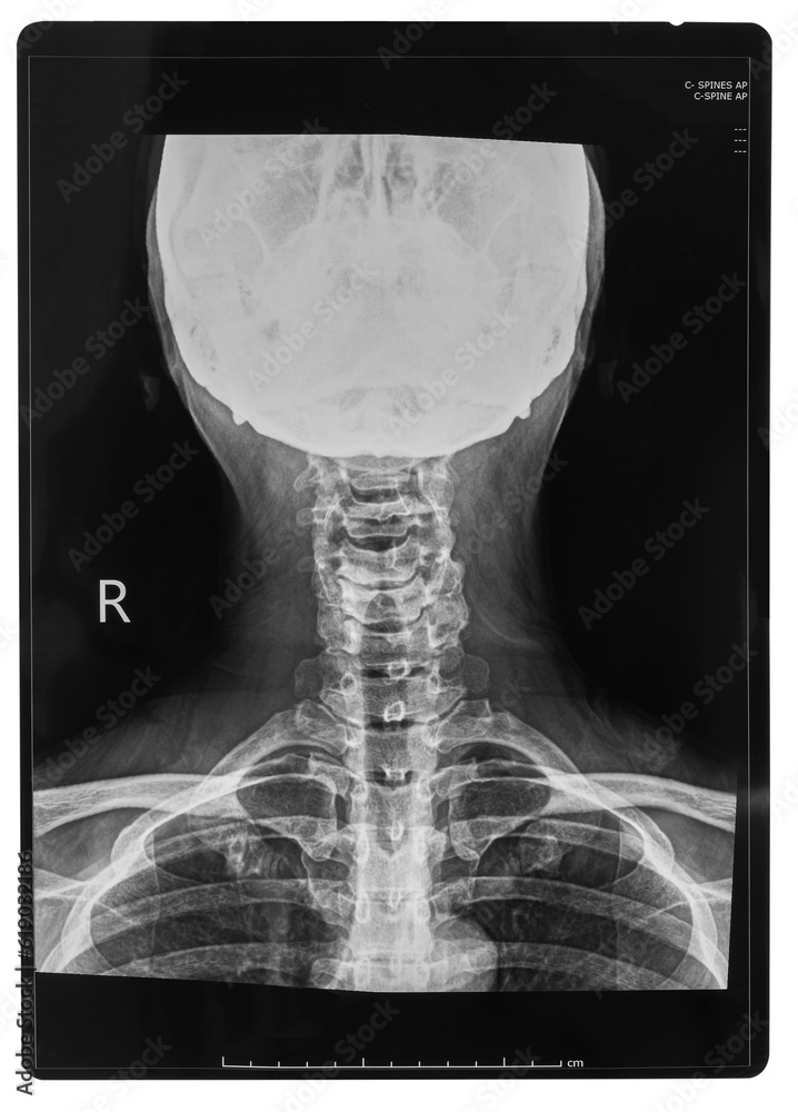 C-spine x-ray or Cervical spine image AP rear view of female patient ...