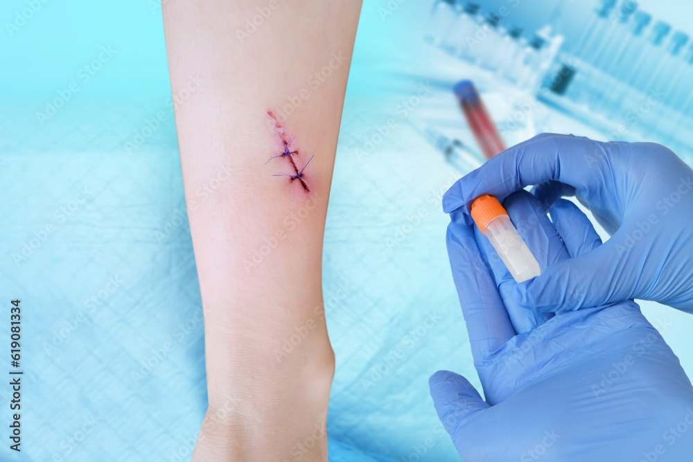 fresh wound on child's leg, wound care in hospital, non-absorbable ...