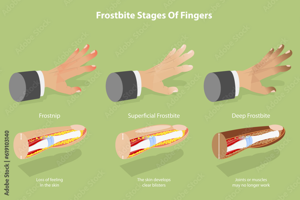 3d Isometric Flat Vector Conceptual Illustration Of Frostbite Stages Of