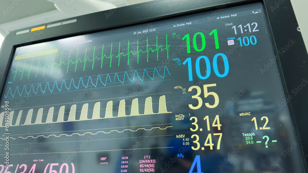 Hospital monitor displaying vital signs: heart rate, blood pressure ...