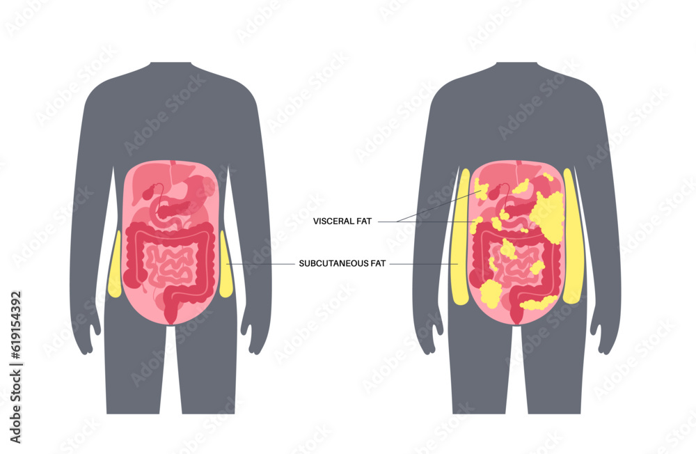 Visceral fat diagram Stock Vector | Adobe Stock