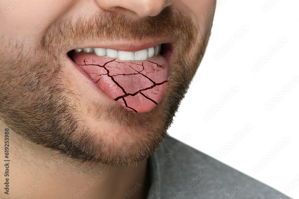 Dry Mouth Symptom Man Showing Dehydrated Tongue On White Background