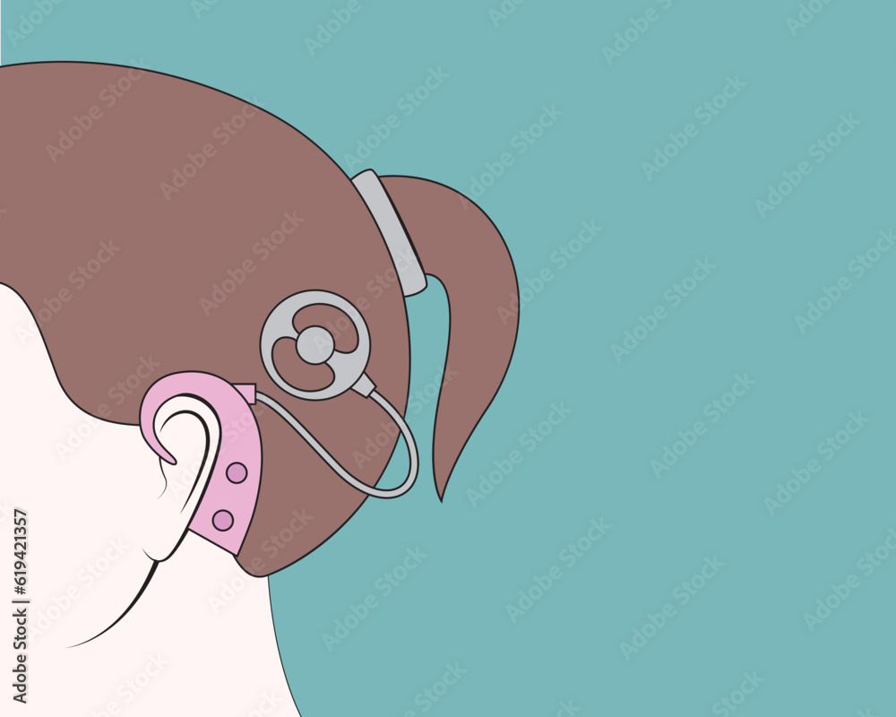 Cochlear implant on a girl's head. Medical background or poster. Vector ...