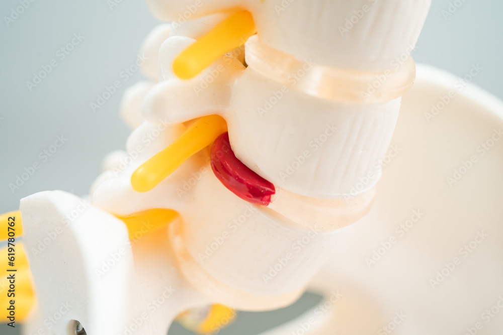 Lumbar spine displaced herniated disc fragment, spinal nerve and bone ...