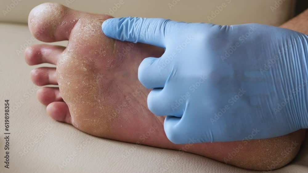 Dry skin, Foot psoriasis The skin is damaged. Dermatitis, eczema ...