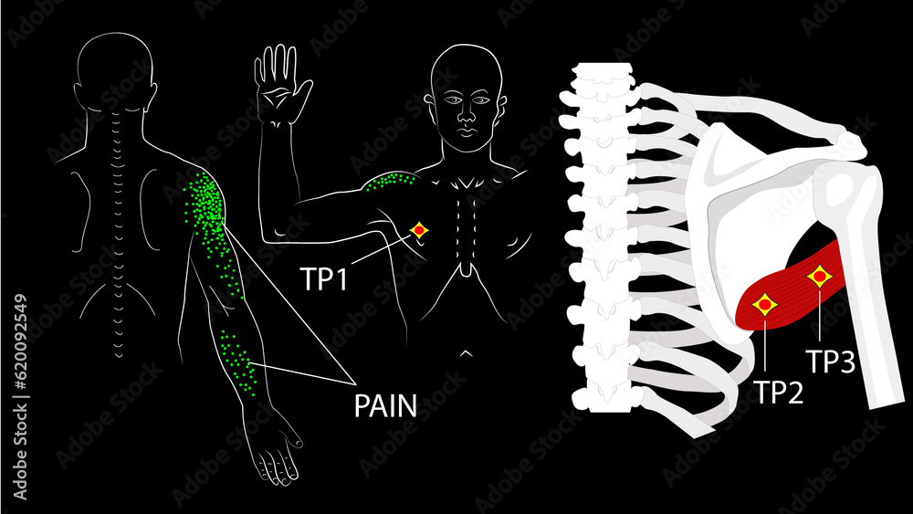 Teres major muscle. Trigger points and referred pain in the arm and ...