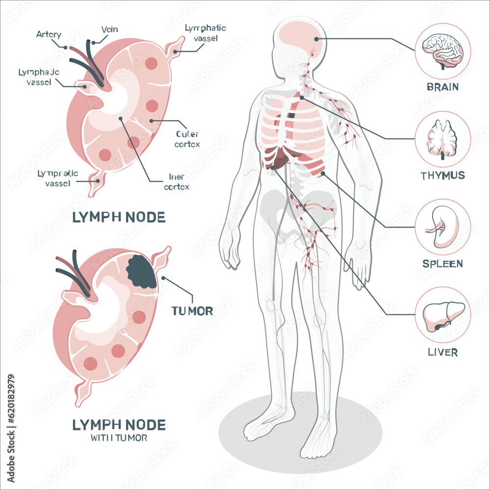 Anatomy of a lymph node with tumor cells. Lymphoma and cancer concept ...