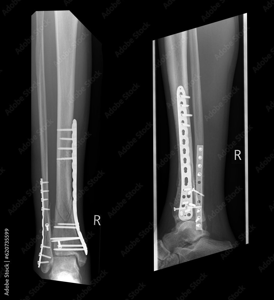 X-Ray of Broken Leg With Metal Plates and Screws Stock Photo | Adobe Stock