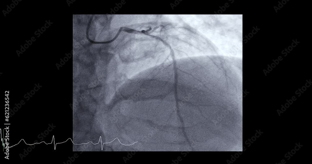 Cardiac catheterization showing coronary arteries used to diagnose and ...