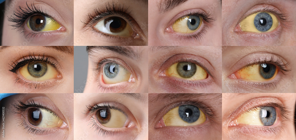 Yellowing of eyes as symptom of hepatitis. Collage with photos of ...