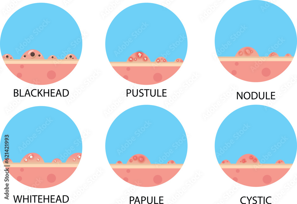 vector collection of types of pimples inside the skin Facial infections ...