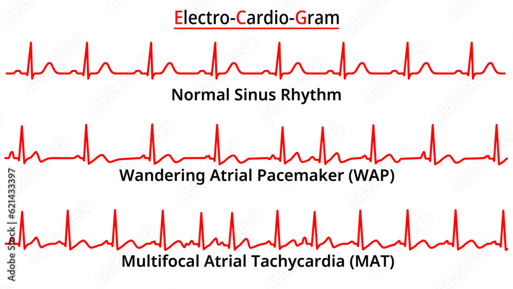 Vetor de Set of ECG Common Abnormalities - Wandering Atrial Pacemaker ... Vetor de Set of ECG Common Abnormalities - Wandering Atrial Pacemaker ...