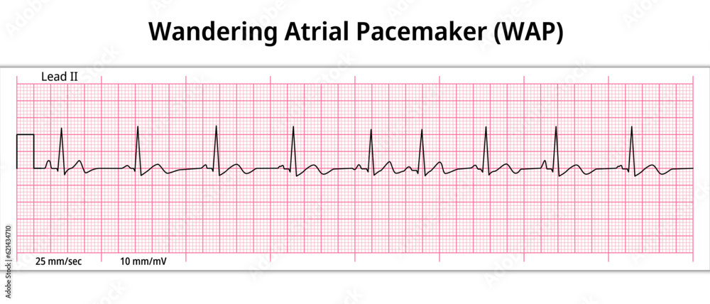 ECG Wandering Atrial Pacemaker (WAP) - 8 Second ECG Paper ...