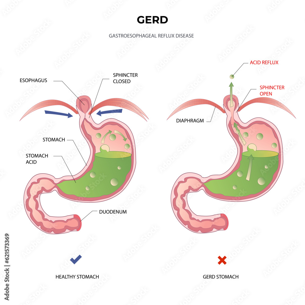 Gerd or gastroesophageal reflux disease with digestive acid outline ...