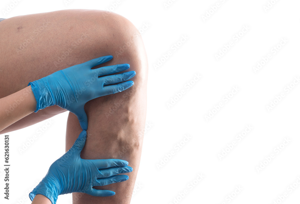 doctor shows the dilation of small blood vessels of the skin on the leg ...