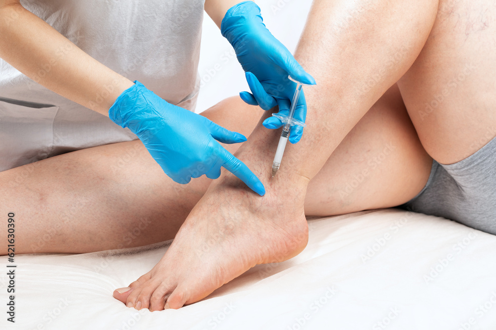 doctor shows the dilation of small blood vessels of the skin on the leg ...