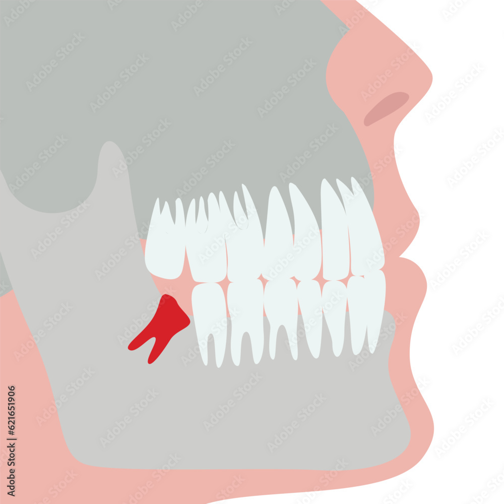 Incorrectly growing wisdom tooth. Medical diagram for backgrounds or ...
