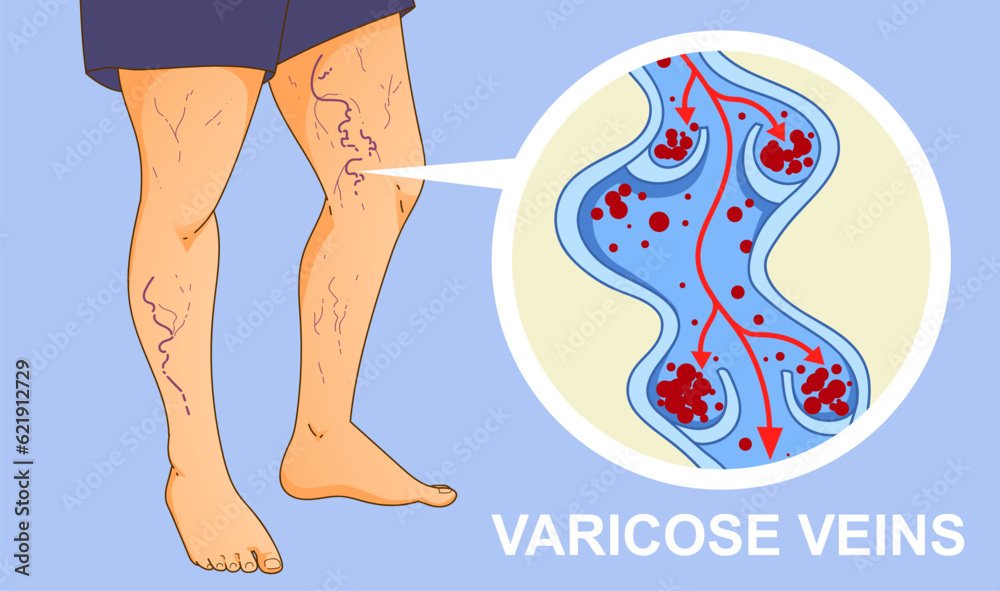 Human body with health problems. Varicose veins. Vector illustration ...