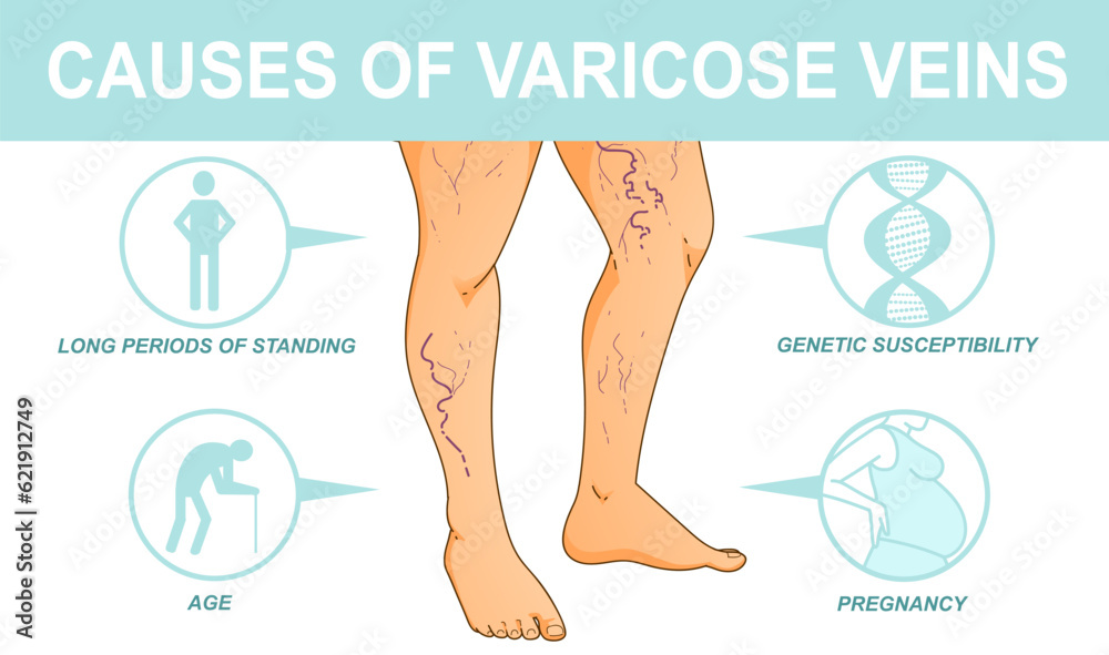 Human body with health problems. Causes of varicose veins. Medical ...