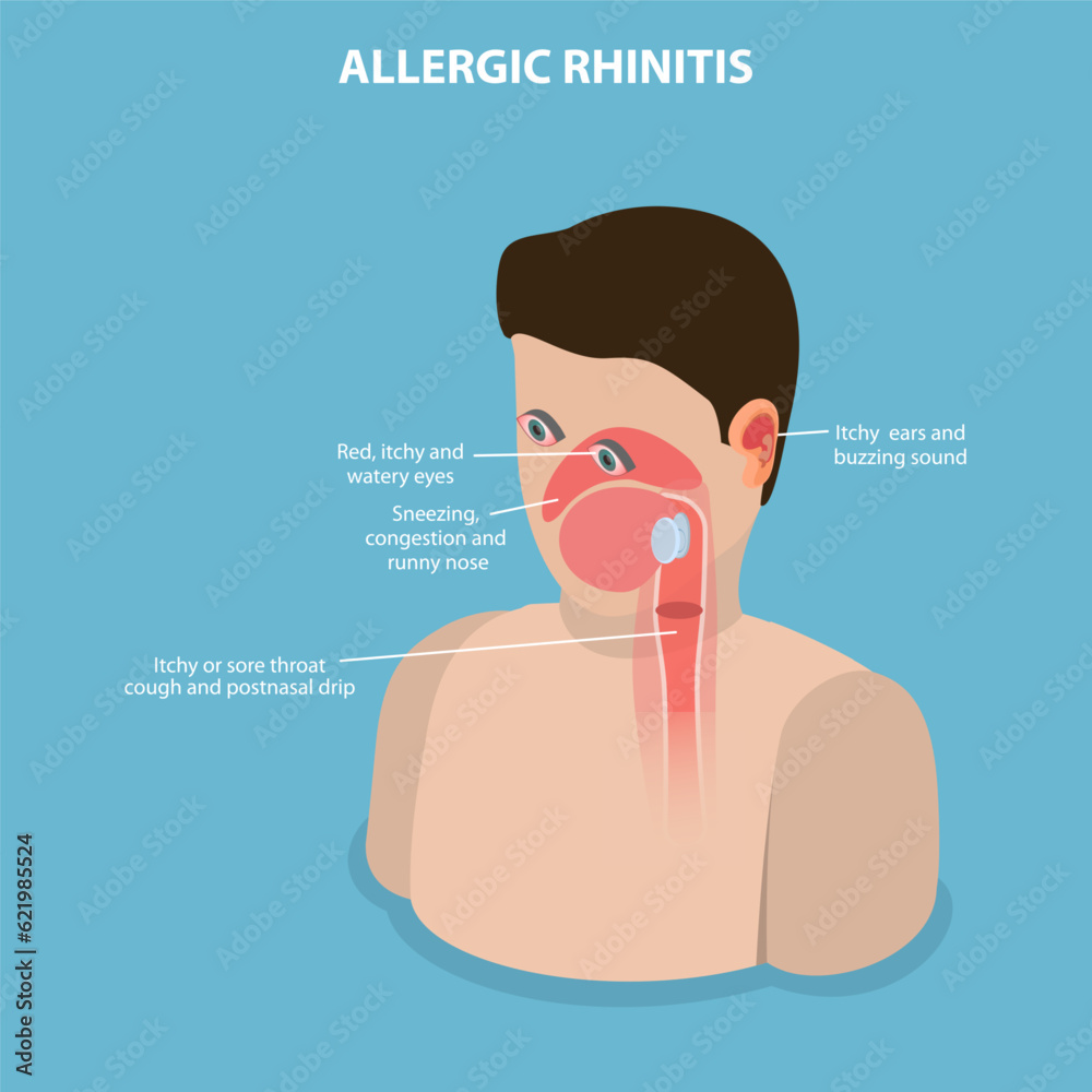 Vetor de 3D Isometric Flat Vector Conceptual Illustration of Allergic ...