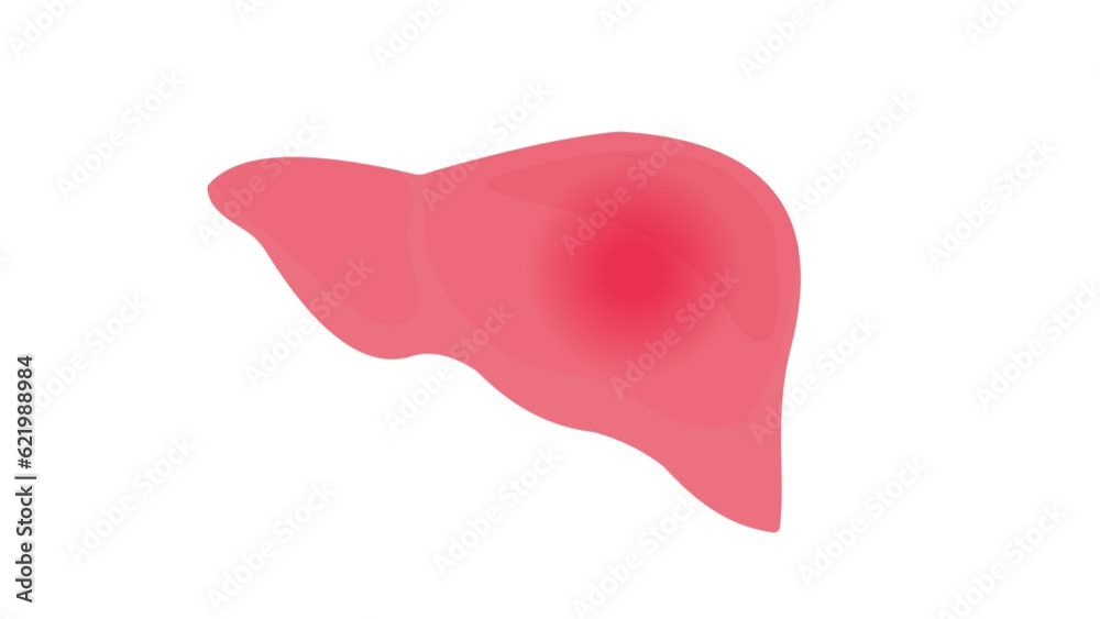 Liver pain and inflammation due to fatty liver hepatitis disease ...