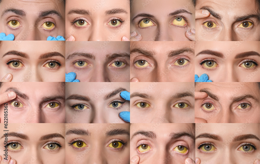 Yellowing of eyes as symptom of hepatitis. Collage with photos of ...