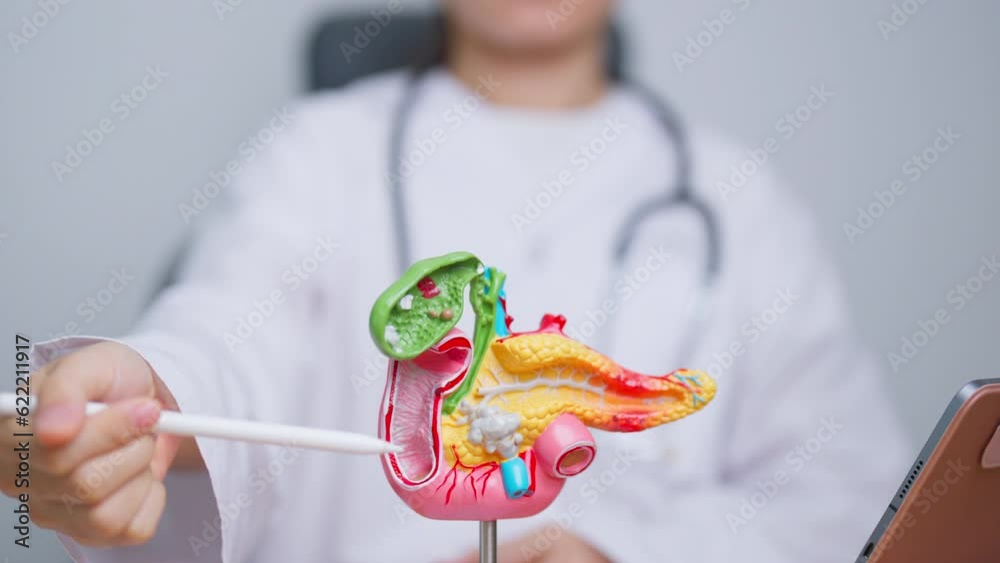 Doctor with human Pancreatitis anatomy model with Pancreas, Gallbladder ...