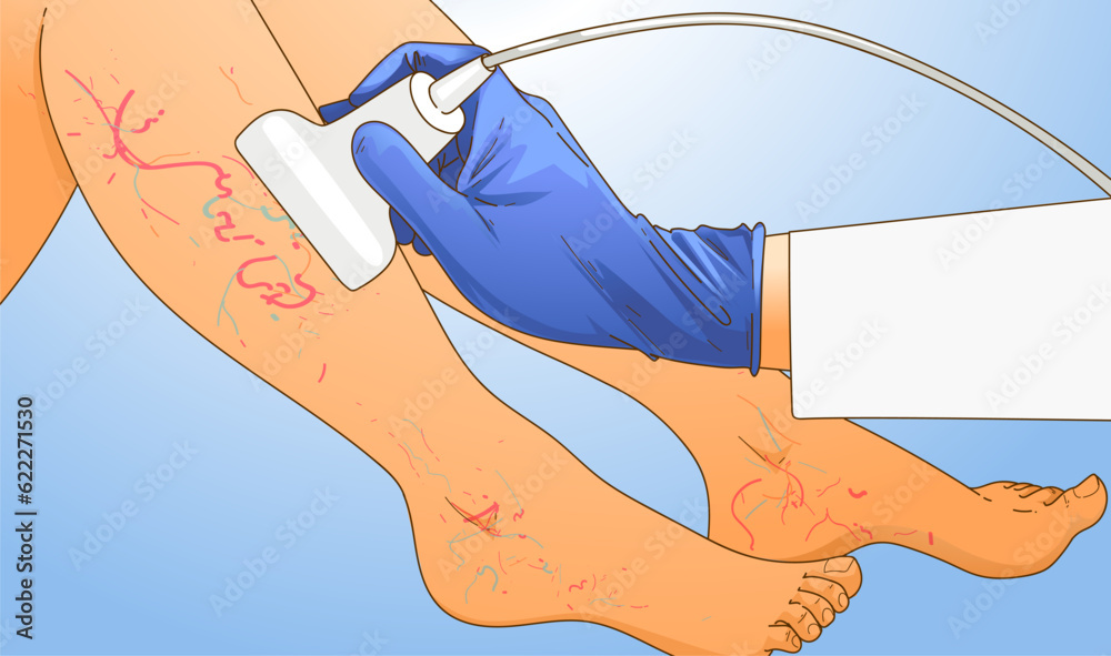 Human legs with health problems. Varicose veins. Diagnosis of varicose ...