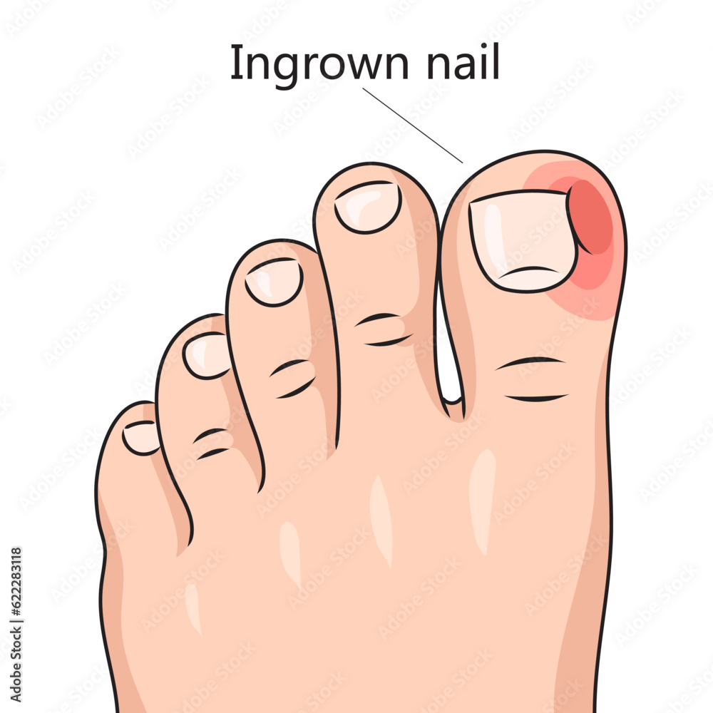 Vetor de Ingrown nail onychocryptosis diagram schematic vector ...