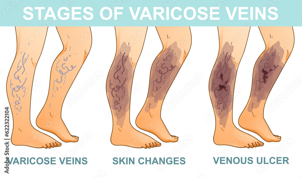 Human legs with health problems. Varicose veins. Stages of vein disease ...
