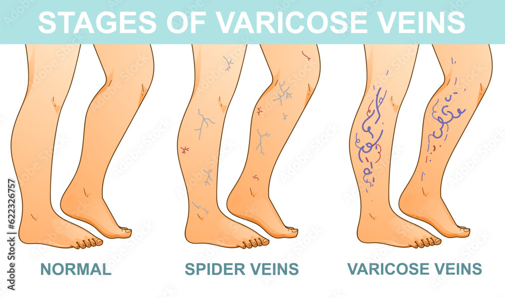 Human legs with health problems. Varicose veins. Stages of vein disease ...
