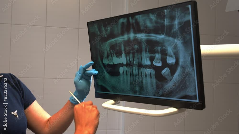 Dentist hand explore study teeth mouth cavity x-ray on monitor describe ...