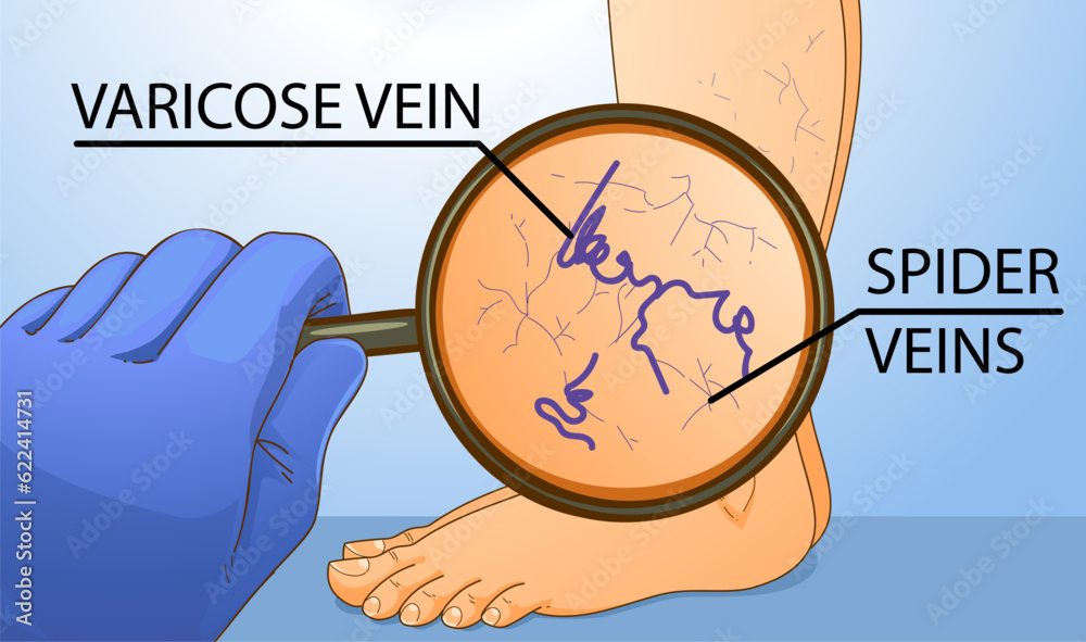 Human legs with health problems. Varicose veins. Diagnosis of varicose ...