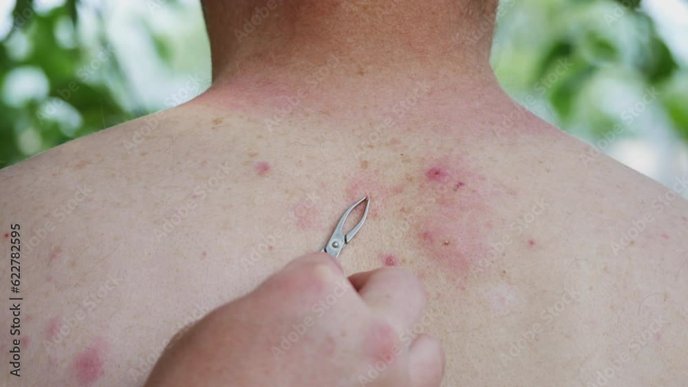 The Process Of Extracting Bee Sting From The Human Body Bee Stings For Health And Healing