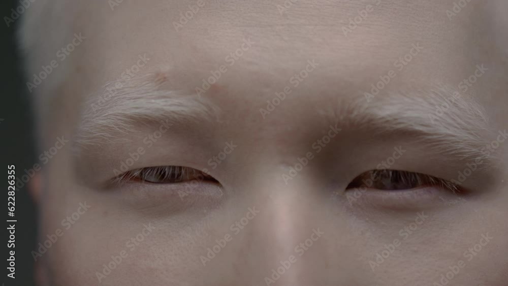 Close up portrait of the eye of an Asian albino guy. Genetic mutation ...