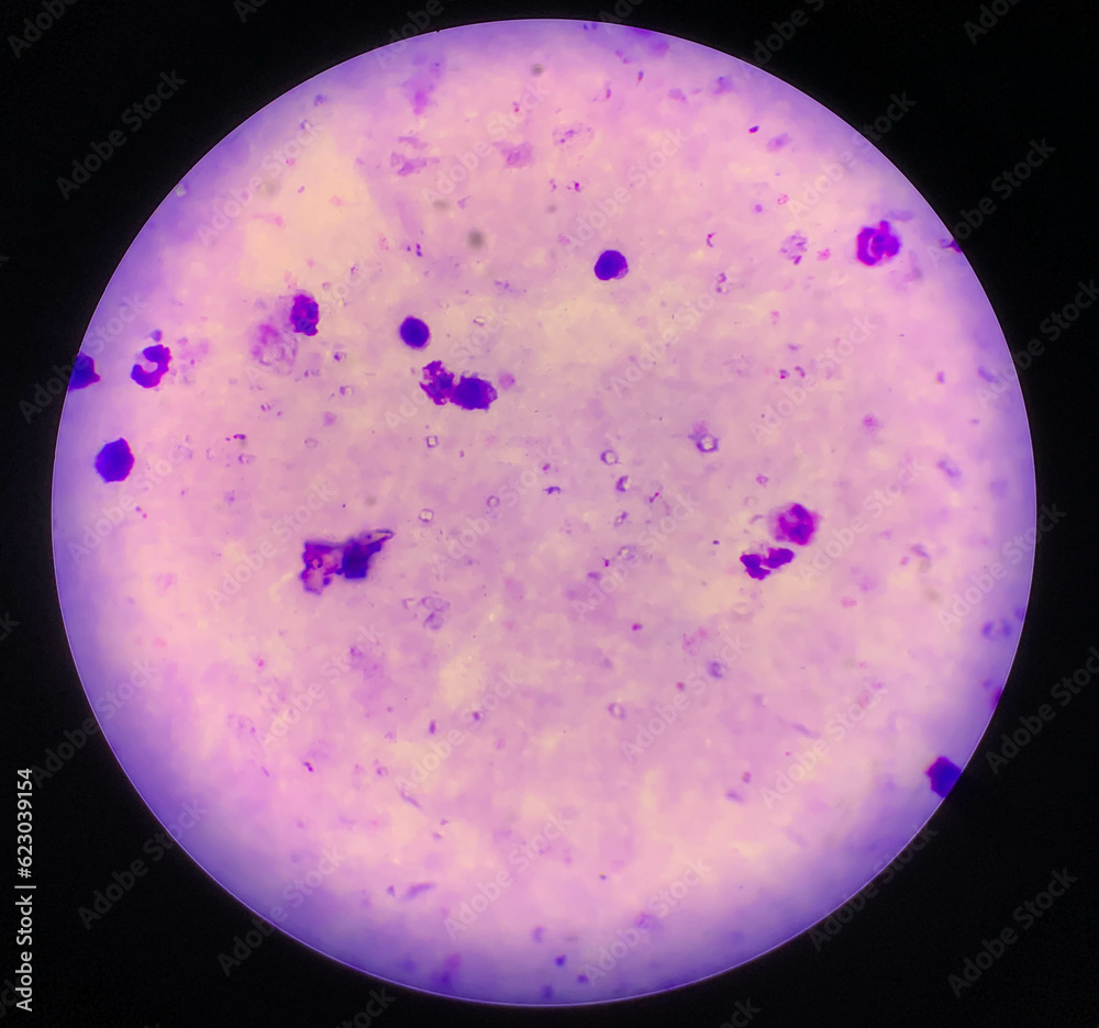 malaria parasite plasmodium falciparum on a thick blood smear reading ...