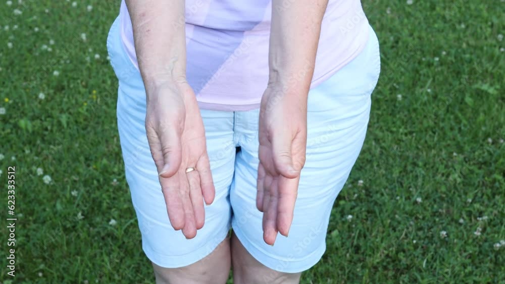 Swollen palm due to a bee sting. A woman showing her swollen hands ...
