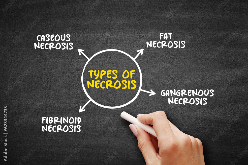 Types of Necrosis (death of body tissue) mind map text concept for ...