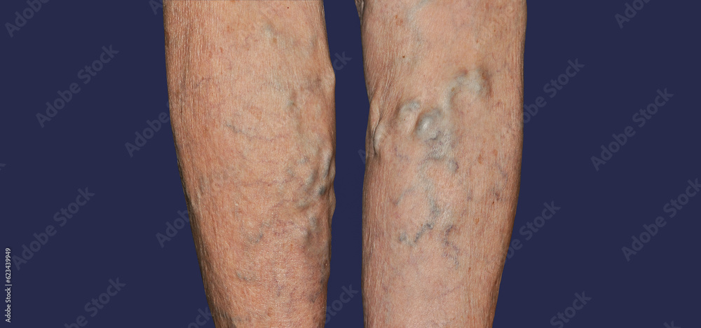 Varicose veins on a female legs. Phlebology and DVT. The old age and ...