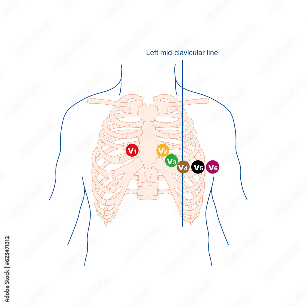 Chest lead is a lead system used to detect the transverse electrical ...