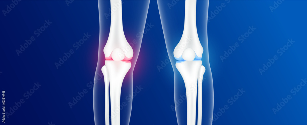 Bone healthy and osteoarthritis or degenerative joint disease ...