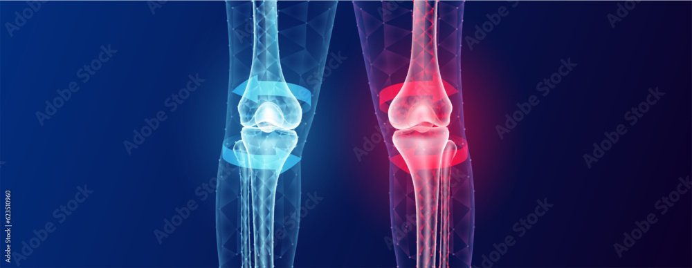 Bone healthy and arthritis knee joint inside leg cartilage becomes worn ...