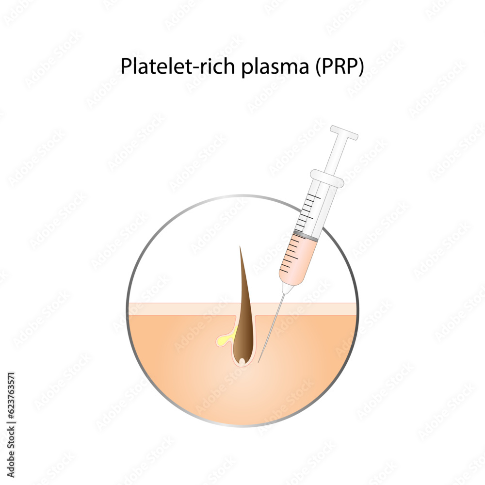 Platelet-rich plasma (prp), a concentrate of platelet-rich plasma ...