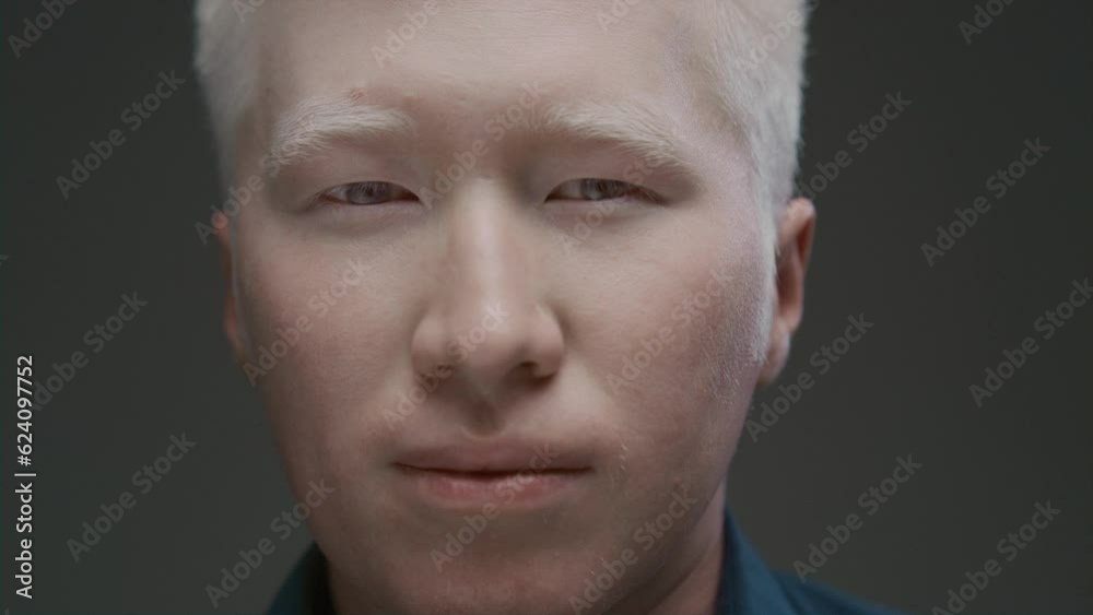 Vidéo Stock Close up portrait of an albino Asian guy looking at the ...