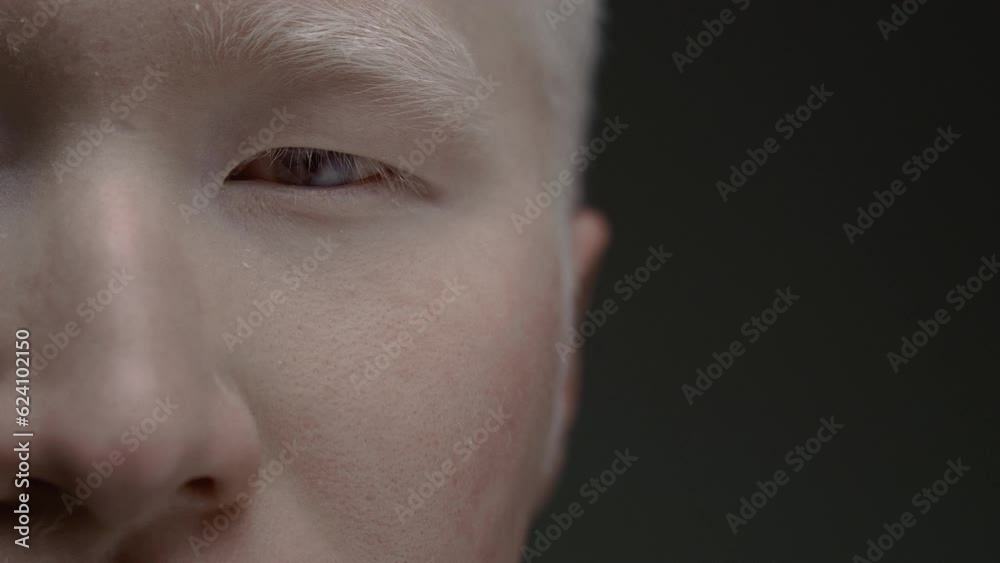 Close up portrait of the eye of an Asian albino guy. Genetic mutation ...
