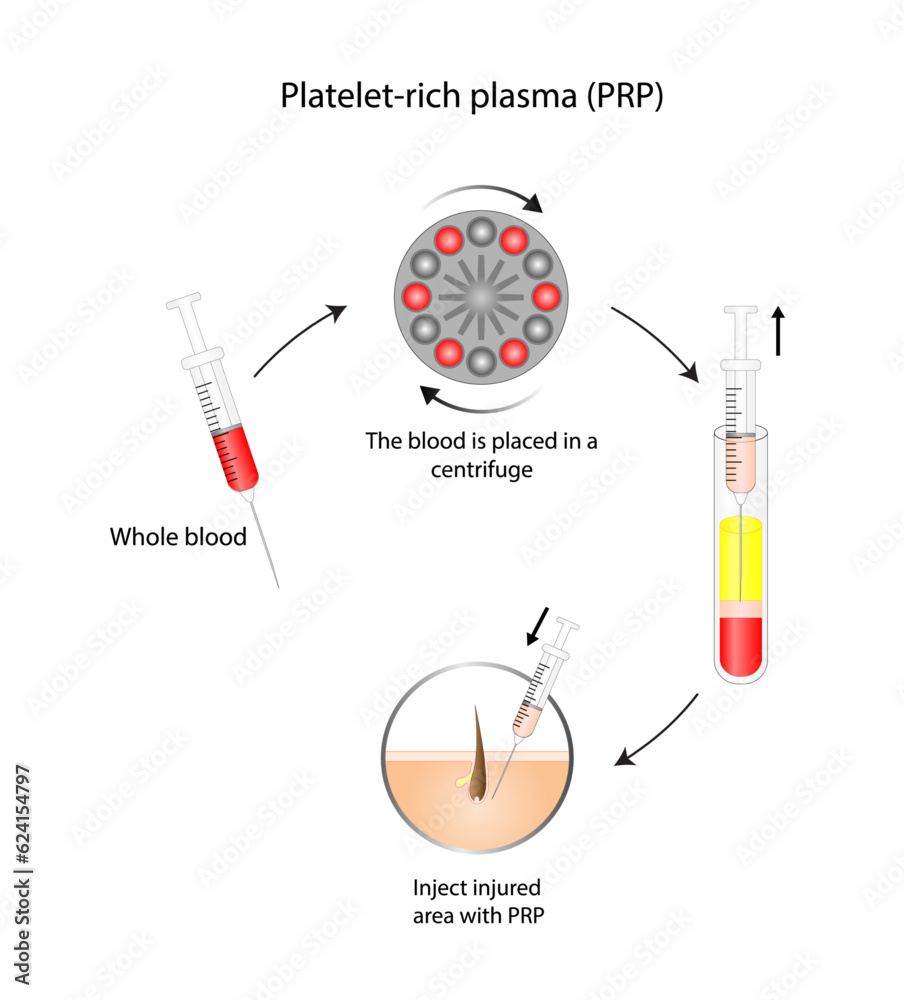 Platelet-rich plasma (prp). Autologous conditioned plasma, is a ...