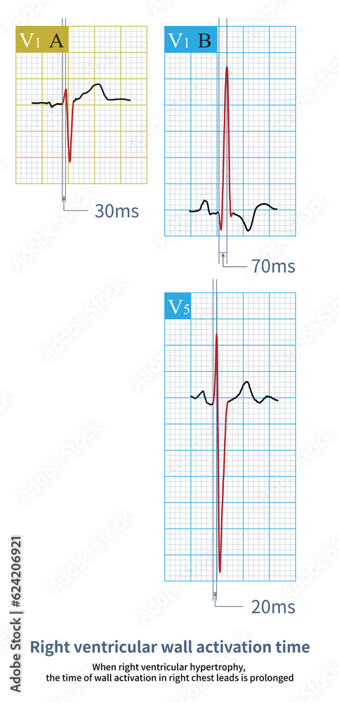 When right ventricular hypertrophy, the time of wall activation in ...